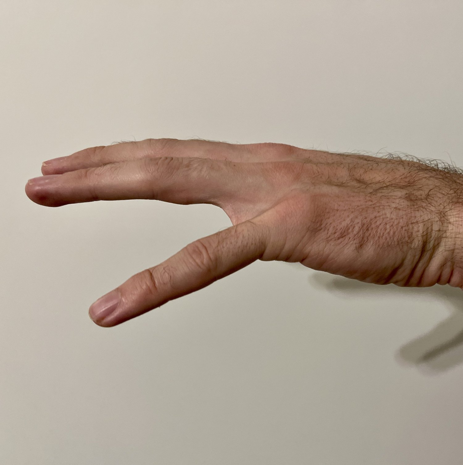 What Is A Boxer’s Fracture? Understanding This Common Hand Injury — Dr ...
