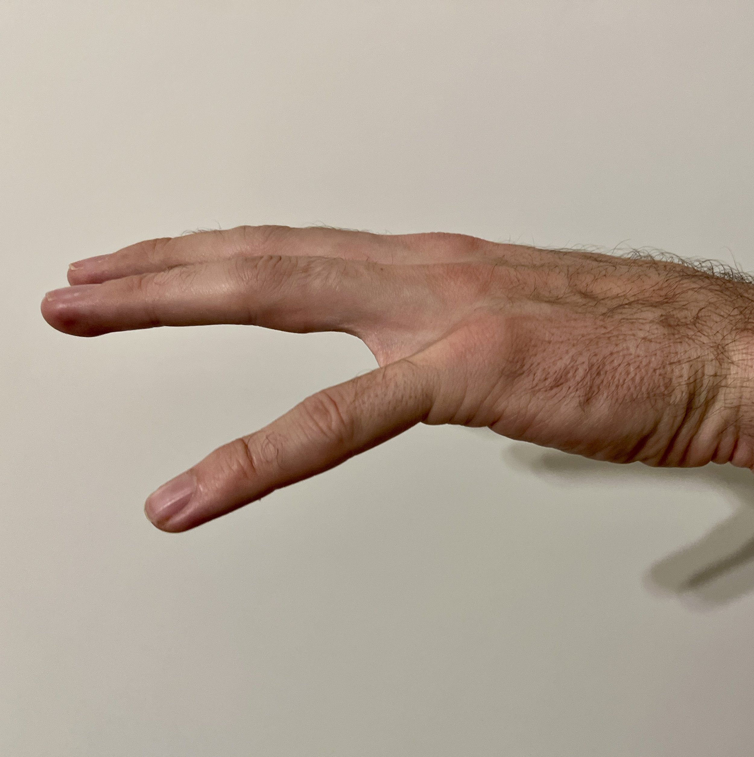 What Is A Boxer’s Fracture? Understanding This Common Hand Injury — Dr ...