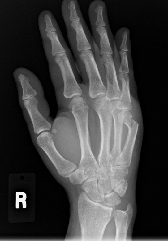 What Is A Boxer’s Fracture? Understanding This Common Hand Injury — Dr ...