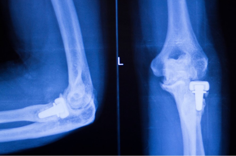 Understanding Radial Head and Neck Fractures: What You Need to Know ...