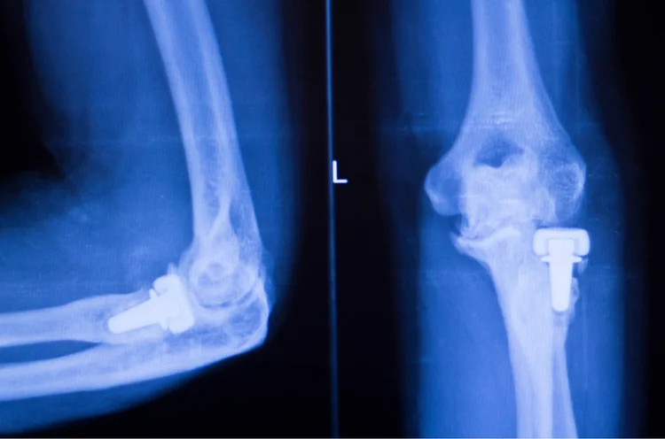 Understanding Radial Head and Neck Fractures: What You Need to Know ...
