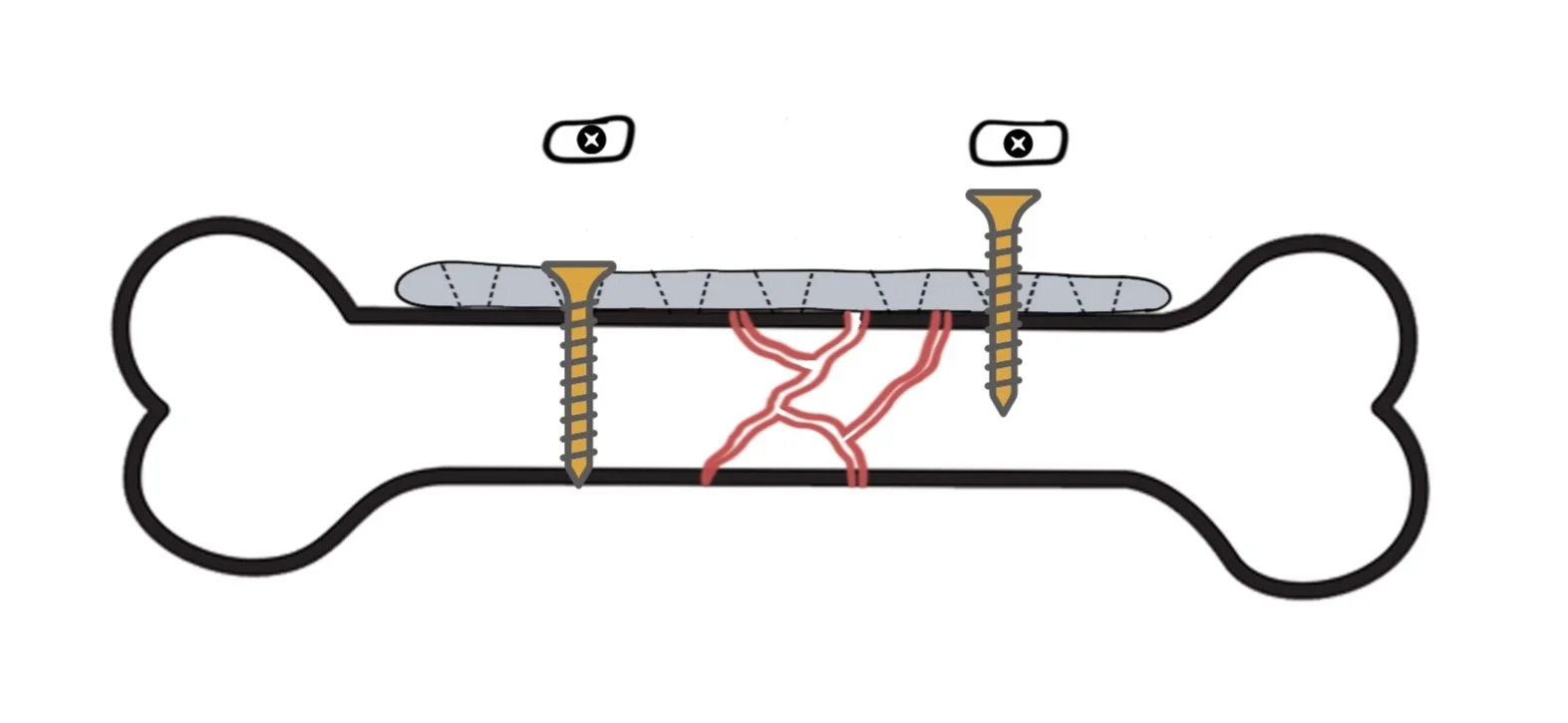 How Orthopedic Surgeons Fix Bones - Part 2 — Dr. Nick Golinvaux