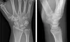 I Have A Broken Wrist: A Primer on Distal Radius Fracture Surgery — Dr. Nick Golinvaux