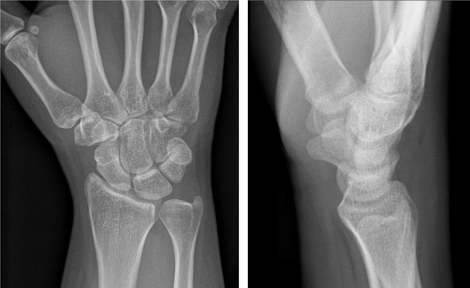 A Patient’s Guide to Distal Radius Fractures — Dr. Nick Golinvaux