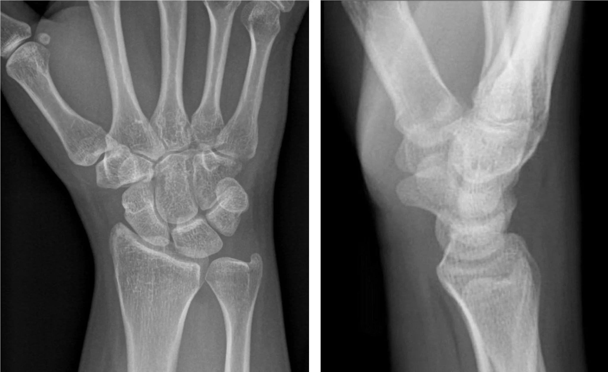 I Have A Broken Wrist: A Primer on Distal Radius Fracture Surgery — Dr ...