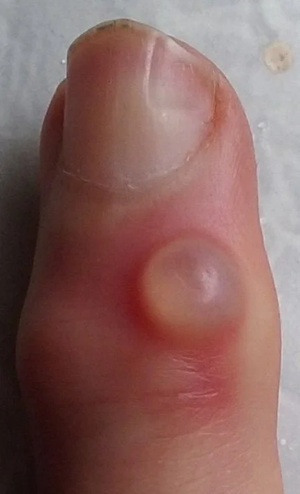 Mucous Cyst and Finger Arthritis | Denver, Colorado — Dr. Nick Golinvaux