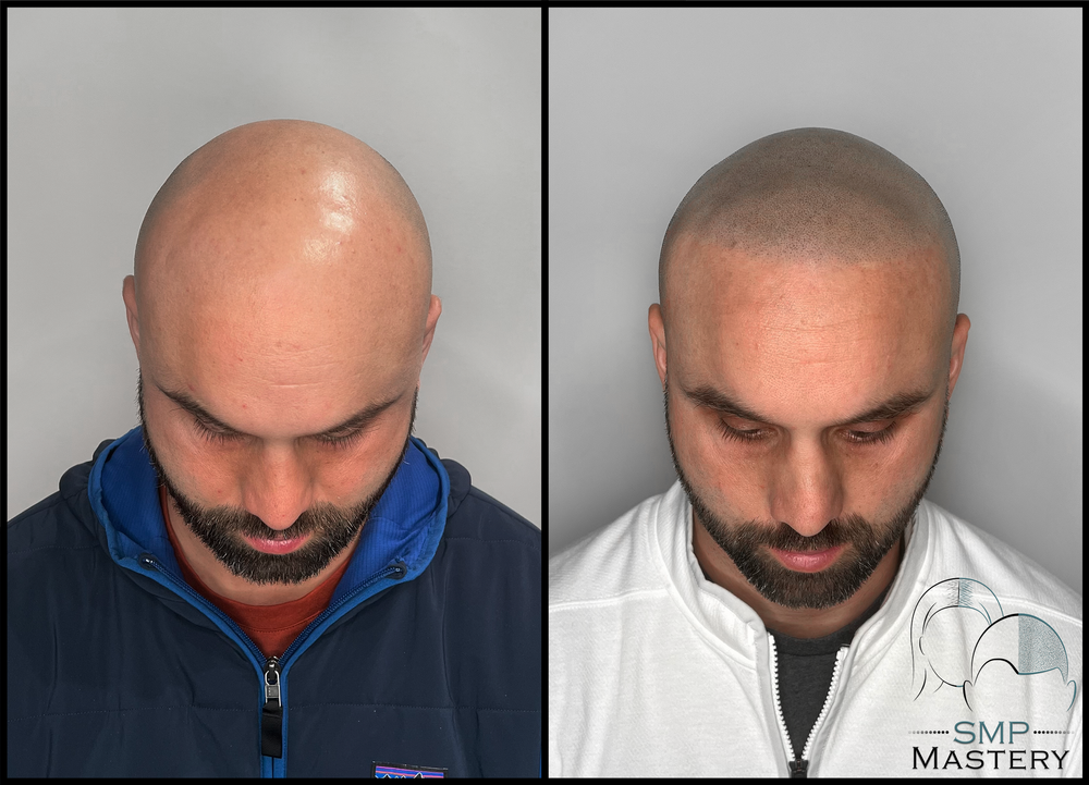 Treatment Options Pros vs Cons — SMP Mastery | Seattle-Area Scalp ...