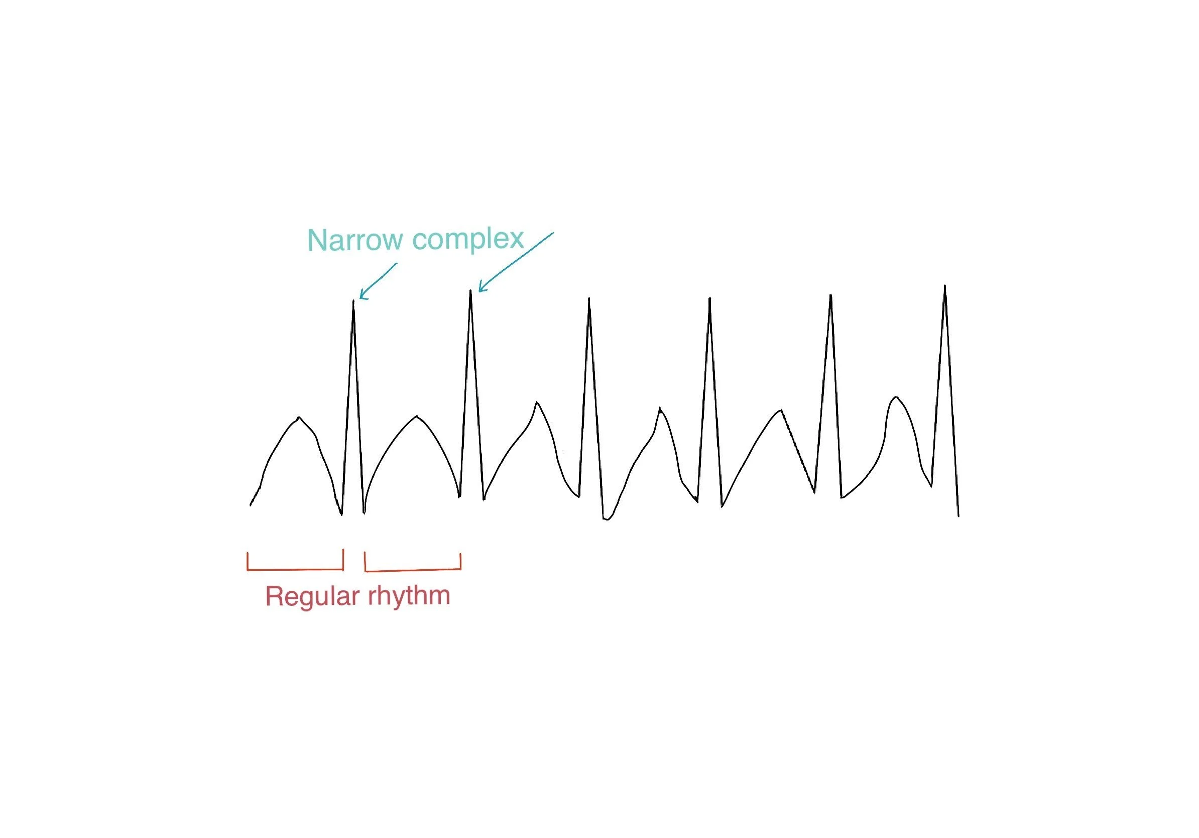 Paroxysmal Supraventricular Tachycardia (psvt)
