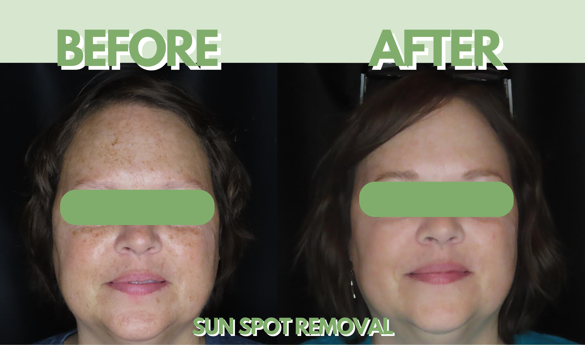 IPL - Sun Spot Removal — Med Spa Mount Dora