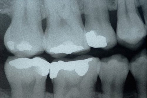 OPG vs Traditional X-rays: What's the Difference for Your Smile ...