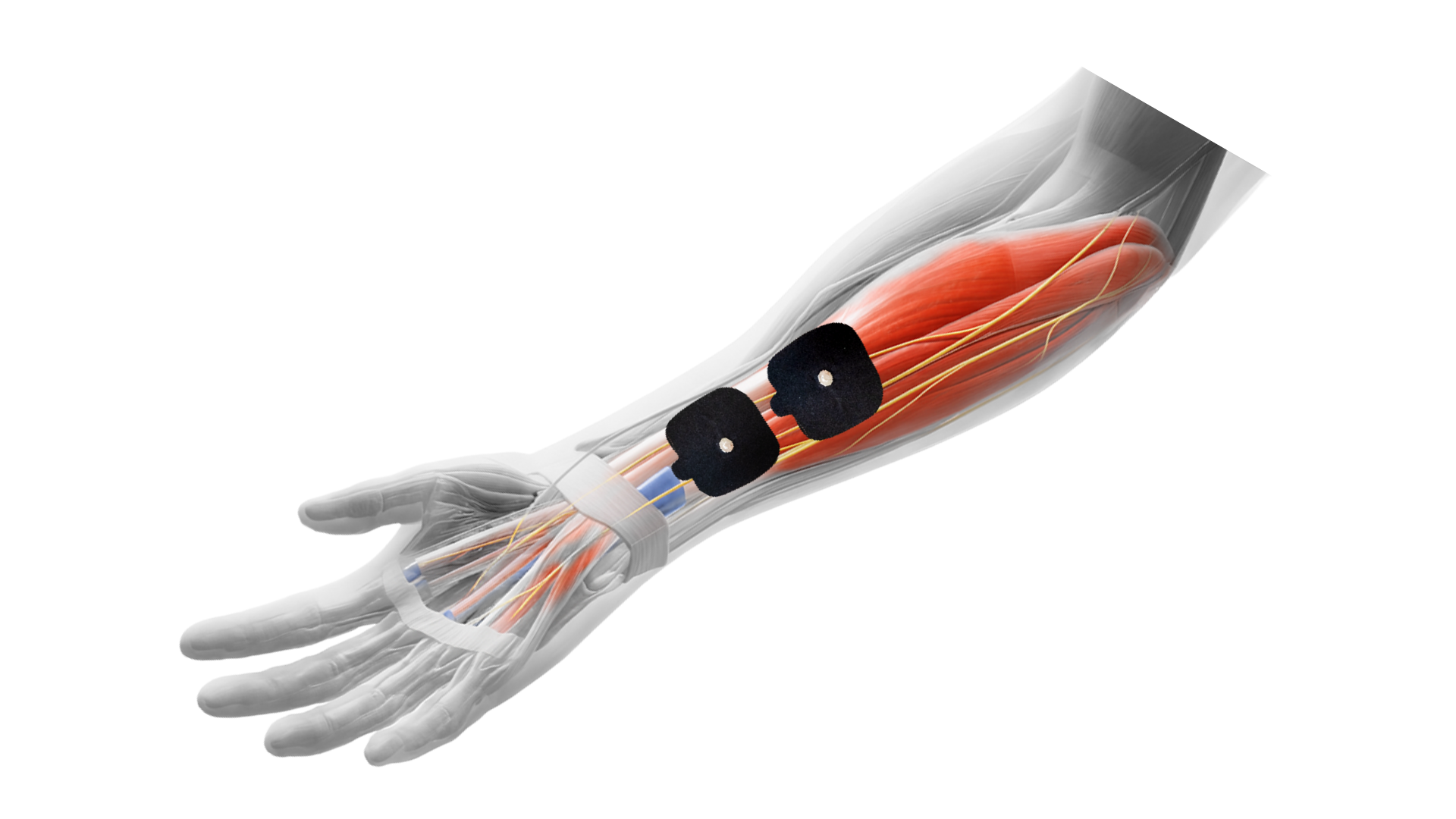 FES Electrode Placements for Upper Limb Stroke Recovery Vol.2 ...