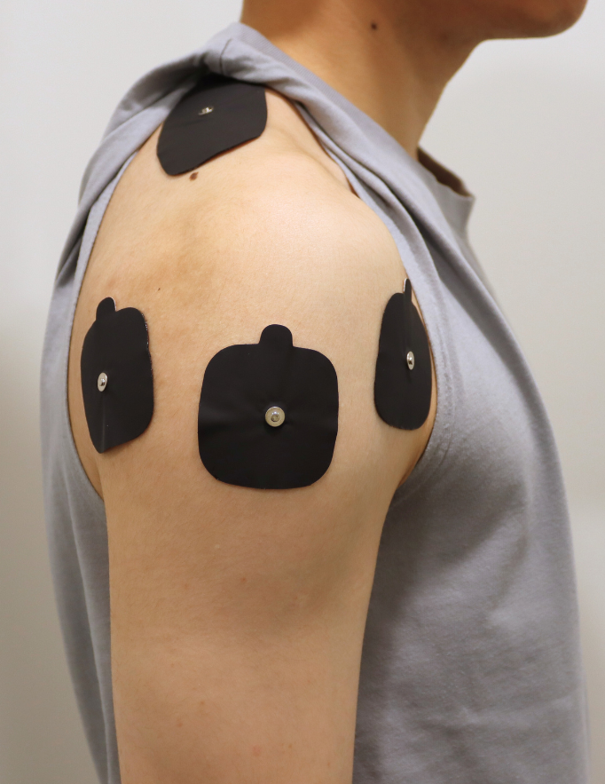 FES Electrode Placements for Upper Limb Stroke Recovery Vol.3 ...
