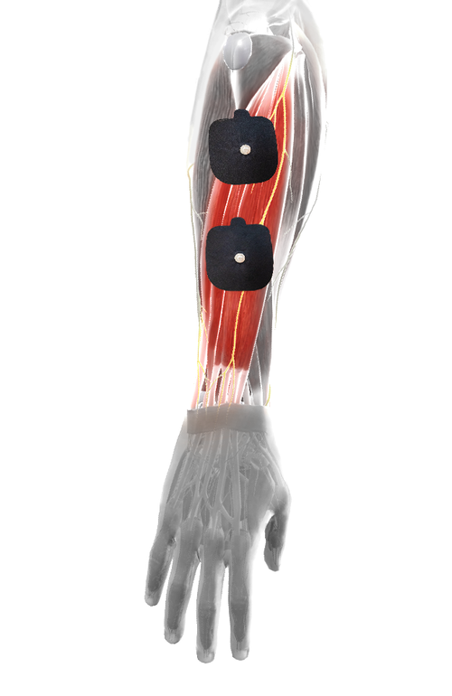 FES Electrode Placements for Upper Limb Stroke Recovery Vol.1 ...