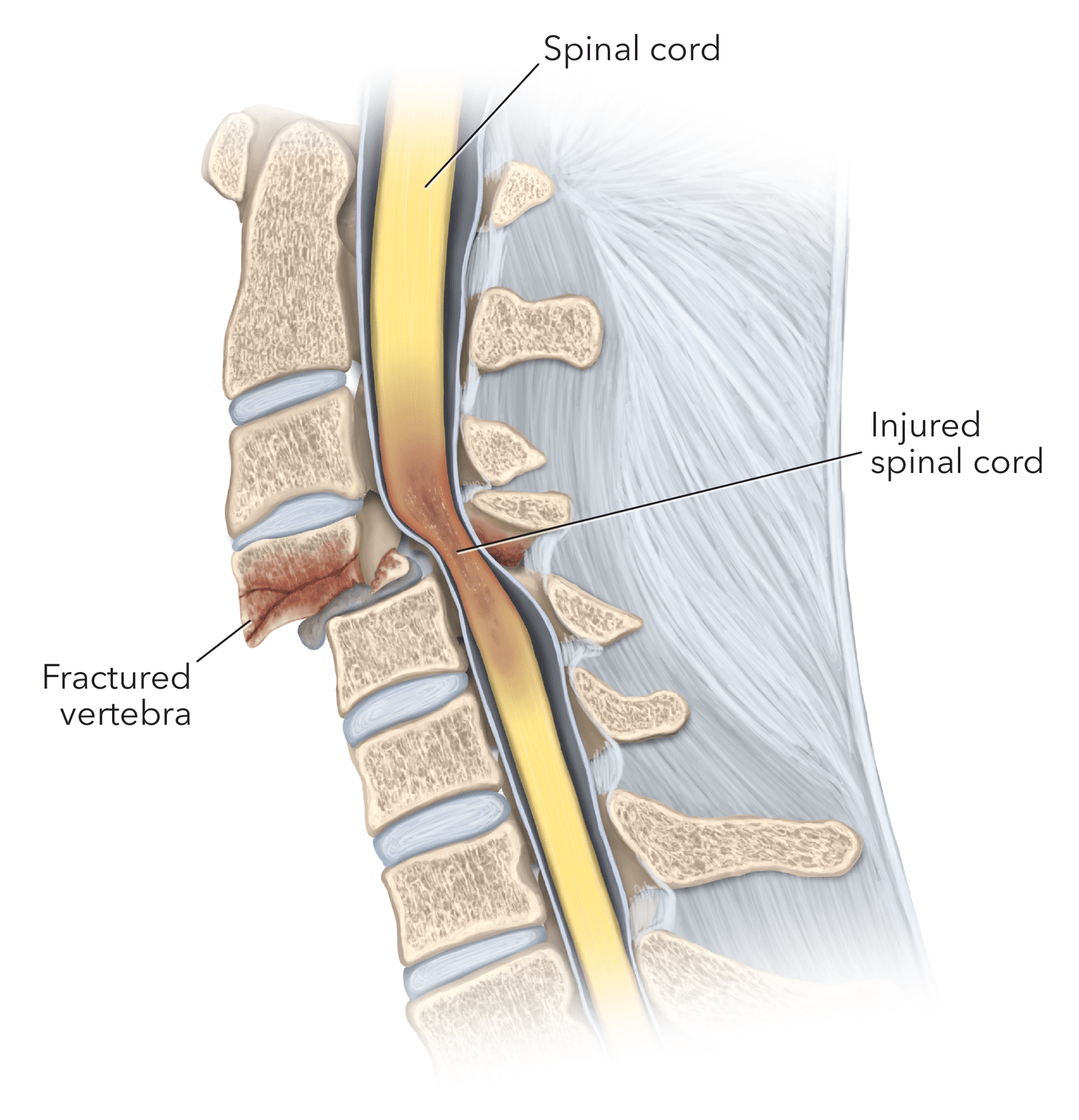 Enhancing Spinal Cord Injury Rehabilitation: The Role of Extended ...