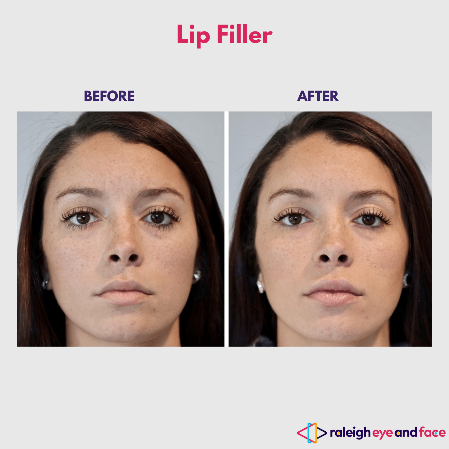 Botulinum Toxin and Filler Before and After Gallery — Raleigh Eye and Face