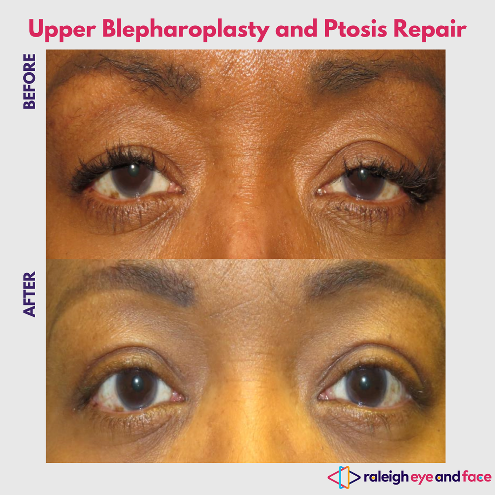 Ptosis Repair Gallery | Ptosis Repair Specialist Raleigh — Raleigh Eye ...