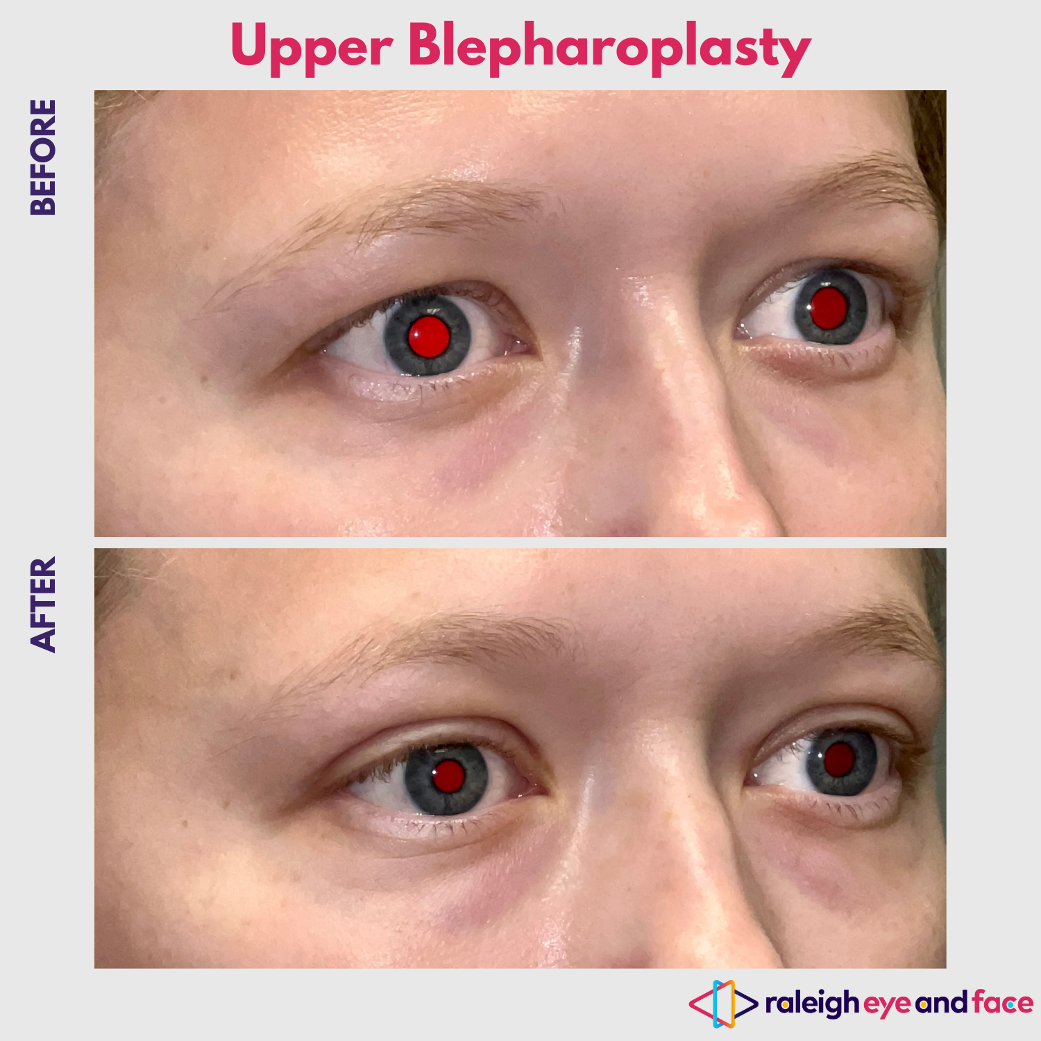 Upper Blepharoplasty Before and After Gallery — Raleigh Eye and Face