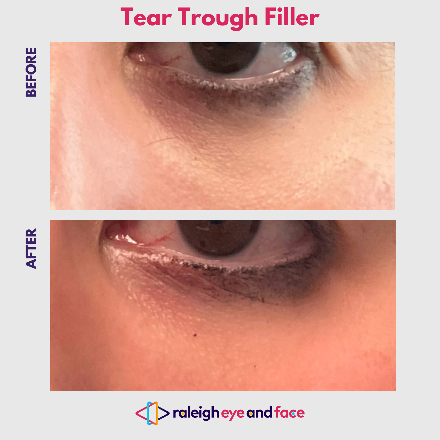 Filler Injections in Raleigh, NC — Raleigh Eye and Face