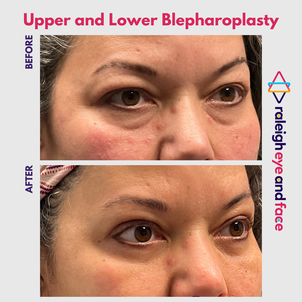 Lower Blepharoplasty Before And After Gallery — Raleigh Eye and Face