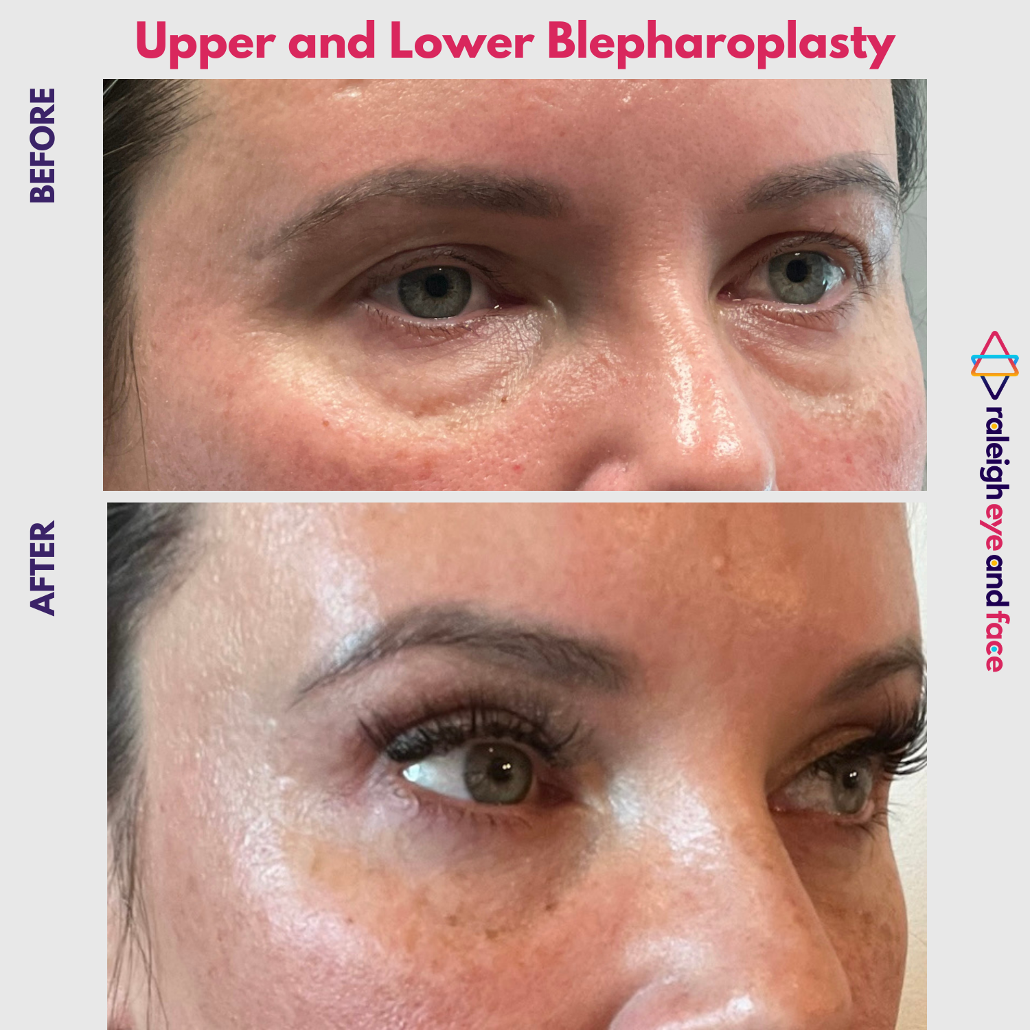 Lower Blepharoplasty Before And After Gallery — Raleigh Eye and Face
