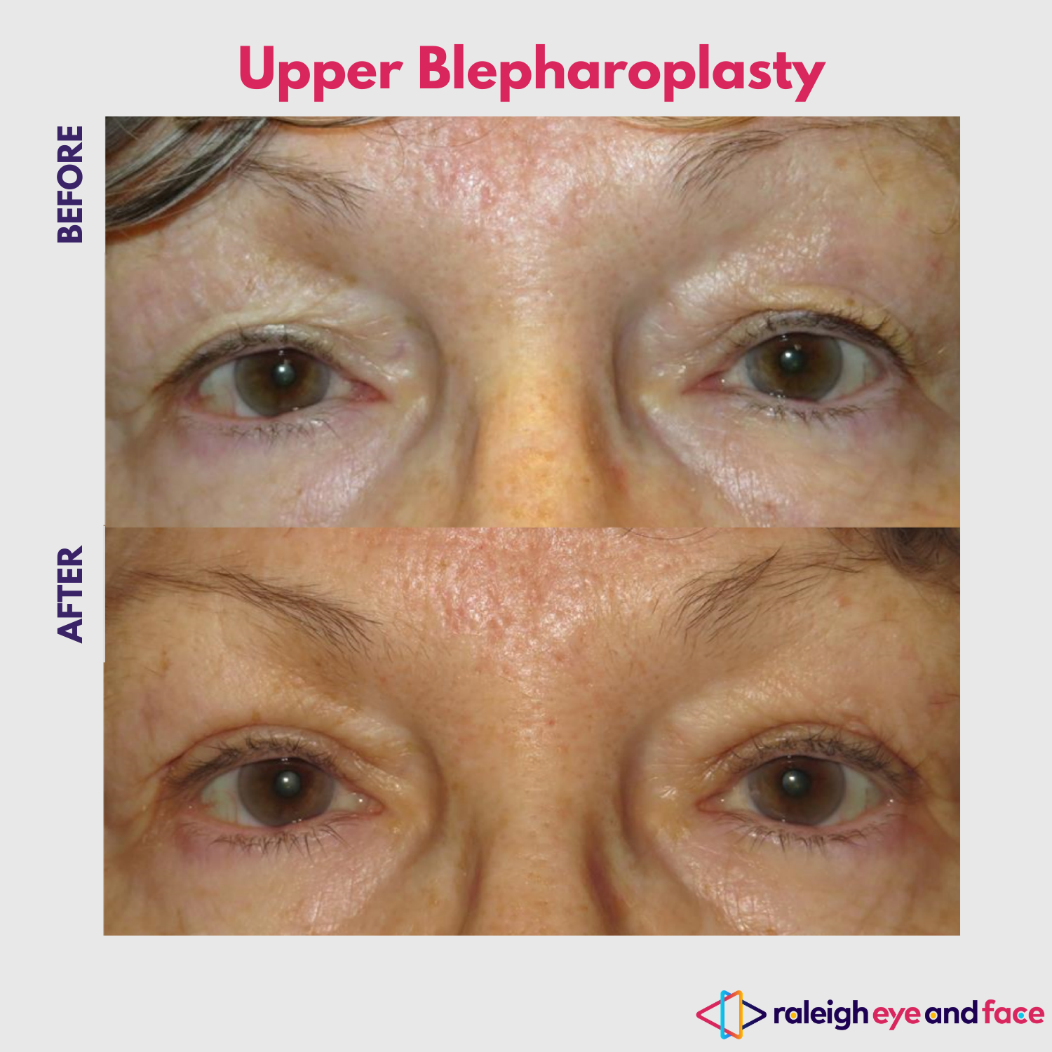 Upper Blepharoplasty Before and After Gallery — Raleigh Eye and Face