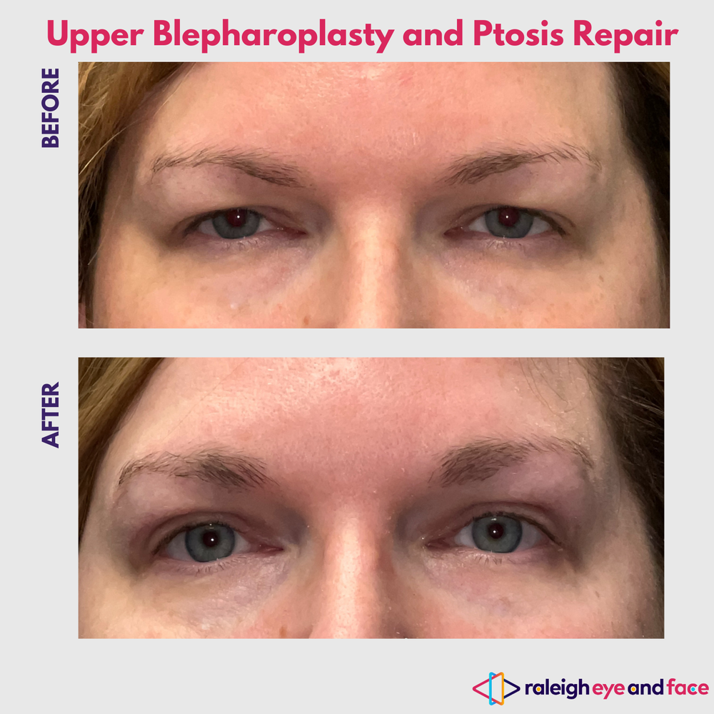 Upper Blepharoplasty Before and After Gallery — Raleigh Eye and Face