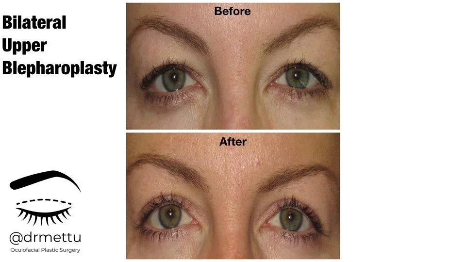 Heavy Upper Eyelid Treatments - Blepharoplasty, Botox, And Filler ...