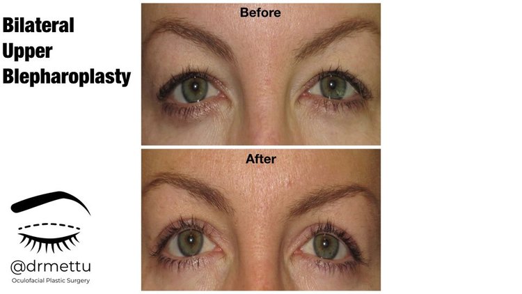 Heavy Upper Eyelid Treatments - Blepharoplasty, Botox, And Filler ...