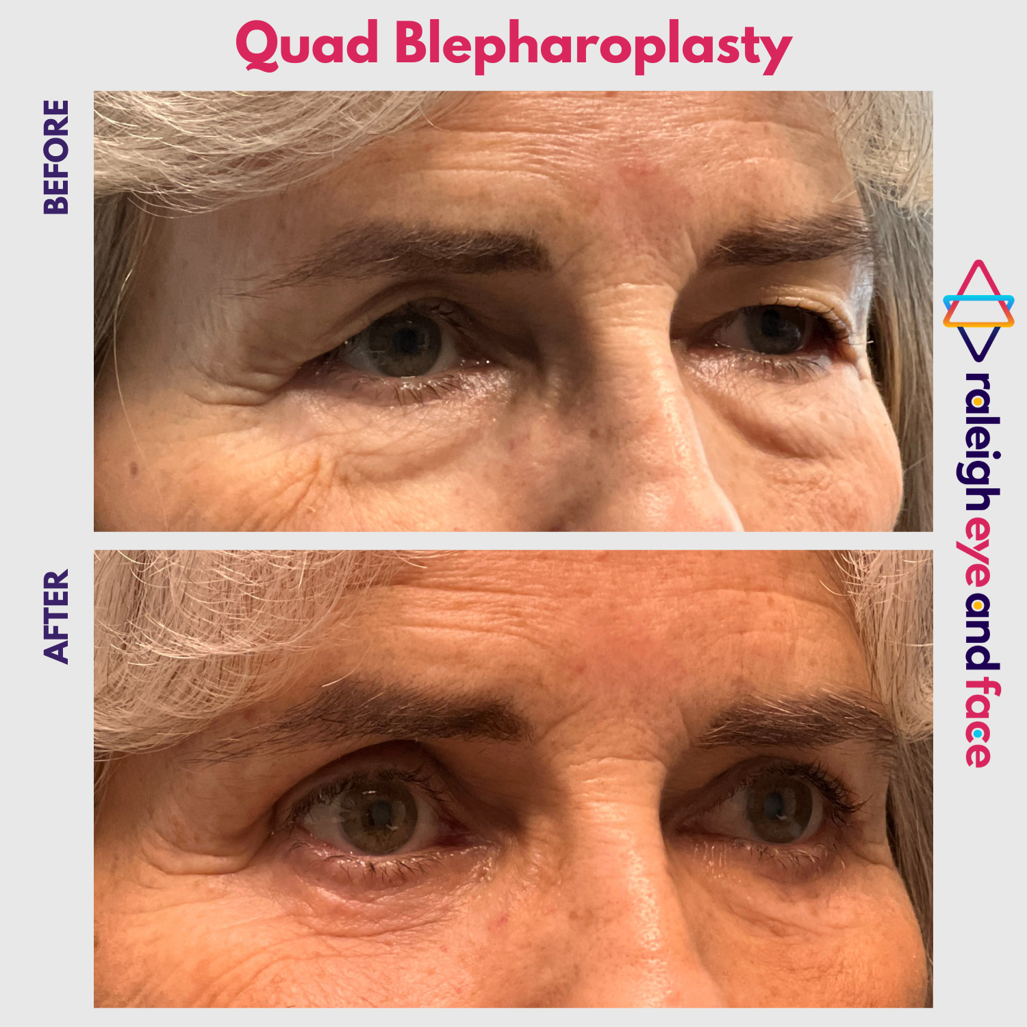 Timing Your Procedures: Blepharoplasty Before or After Cataract Surgery ...