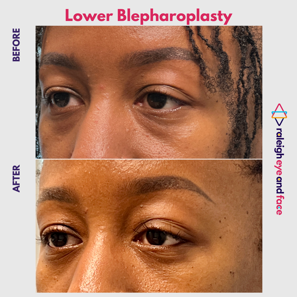 Top Rated Lower Eyelid Surgery Before And After Gallery — Raleigh Eye ...