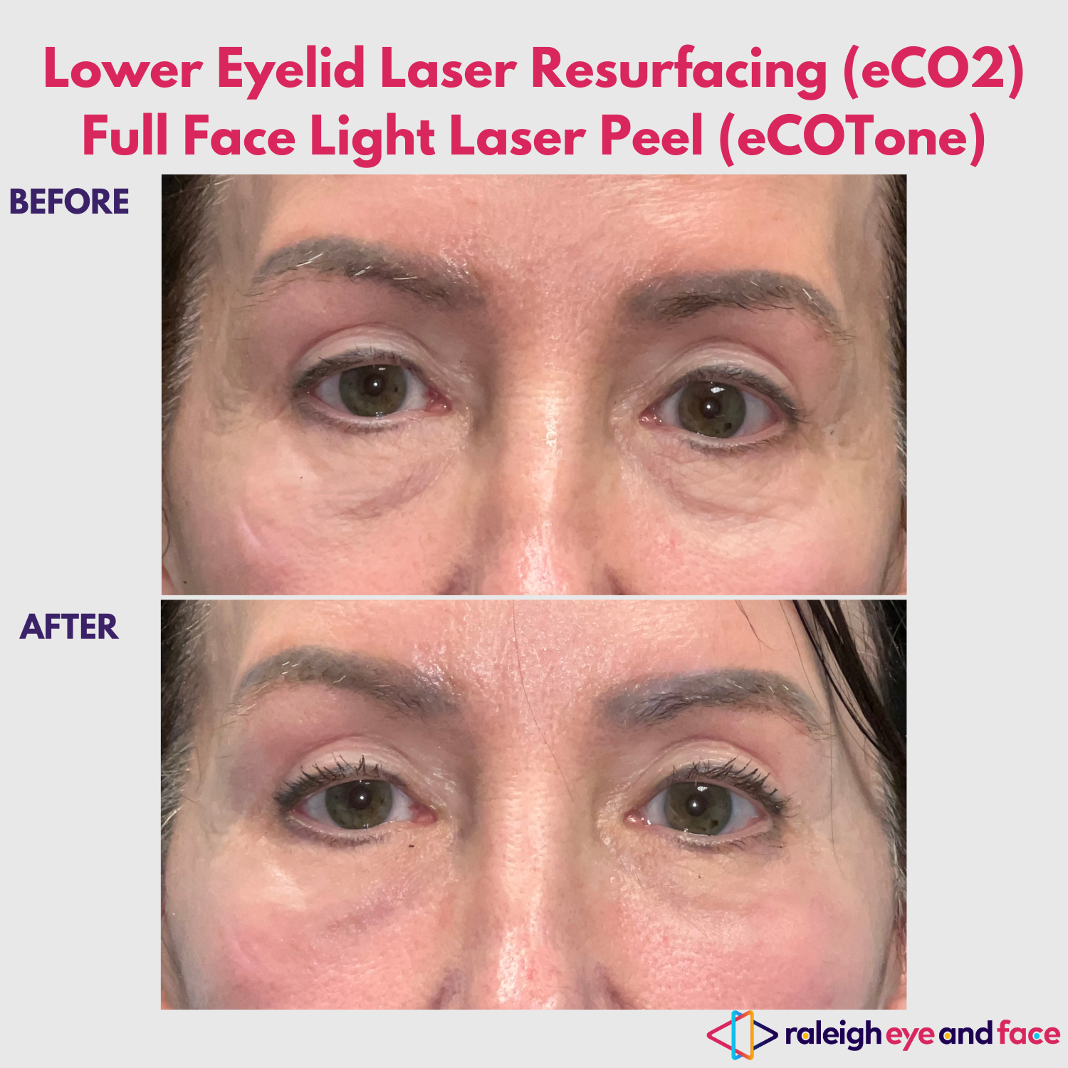 Laser Resurfacing Before and After Gallery — Raleigh Eye and Face
