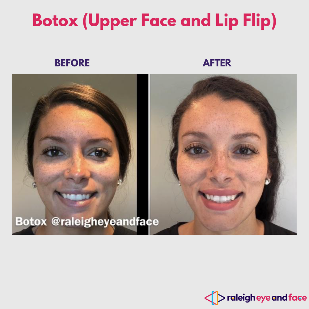 Botulinum Toxin and Filler Before and After Gallery — Raleigh Eye and Face