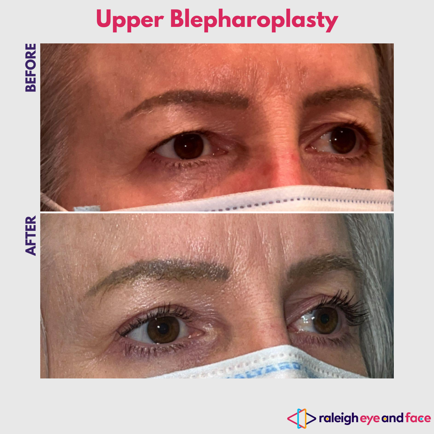 Upper Blepharoplasty Before and After Gallery — Raleigh Eye and Face