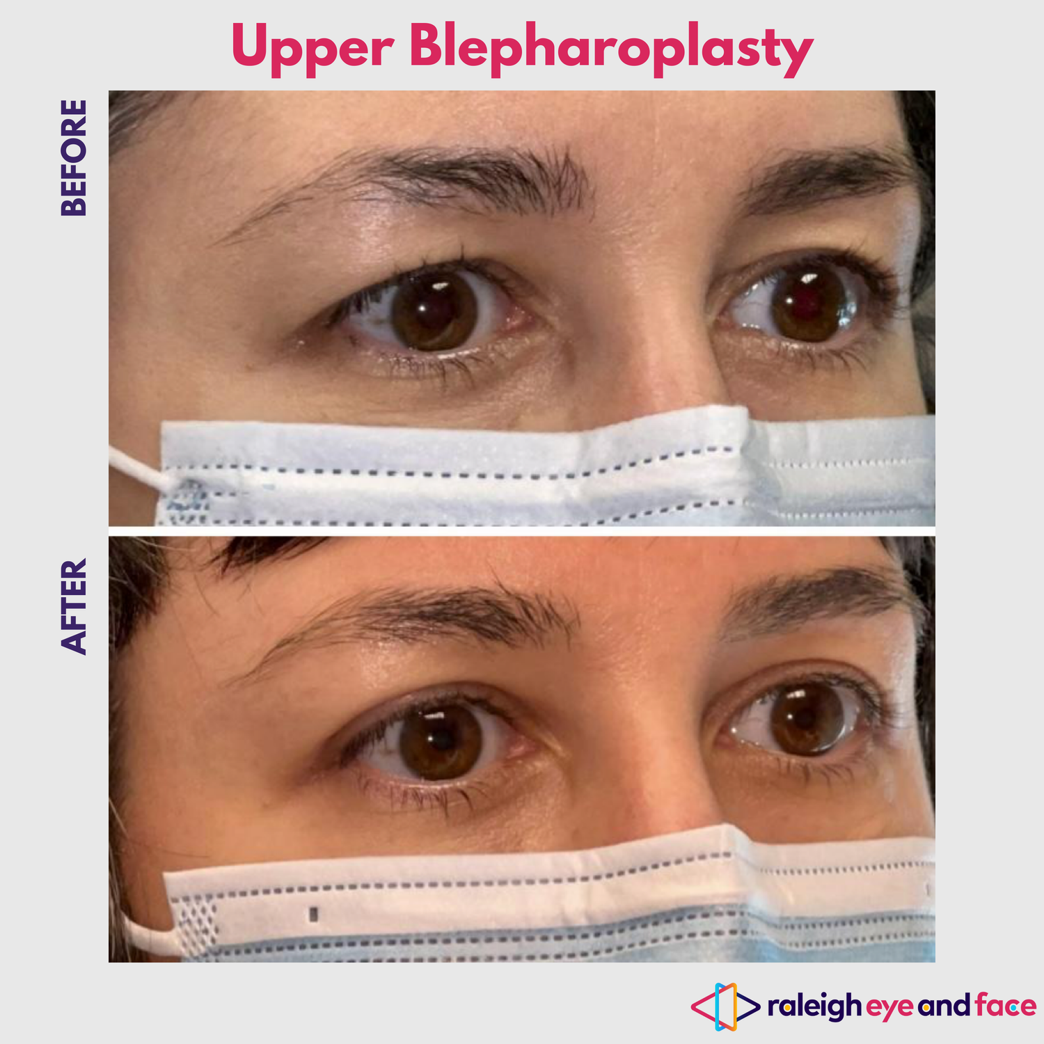 Upper Blepharoplasty Before and After Gallery — Raleigh Eye and Face