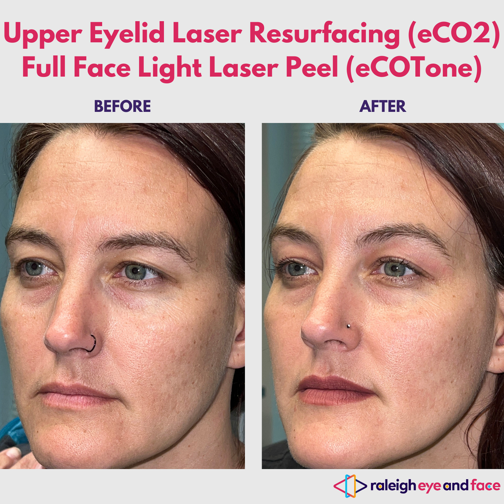Laser Skin Resurfacing Before and After — Raleigh Eye and Face