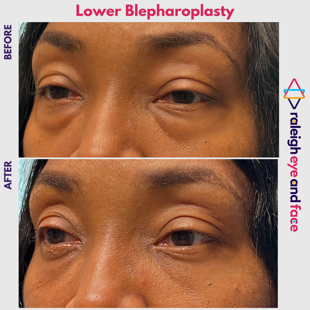 Lower Blepharoplasty Before And After Gallery — Raleigh Eye and Face