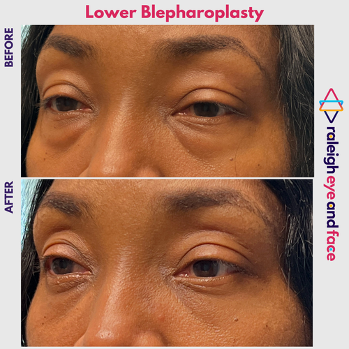 Lower Blepharoplasty Before And After Gallery — Raleigh Eye and Face