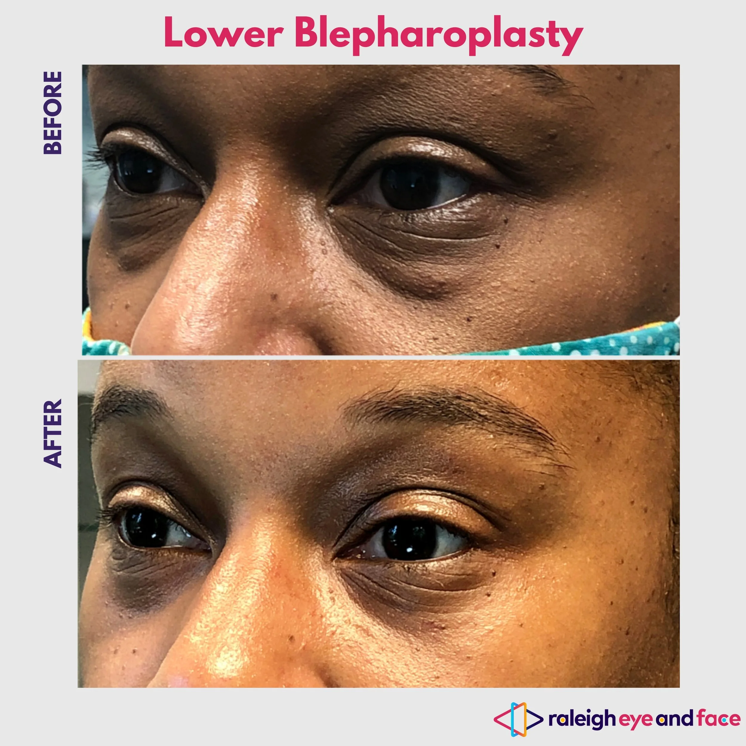 Lower Blepharoplasty Before And After Gallery — Raleigh Eye and Face