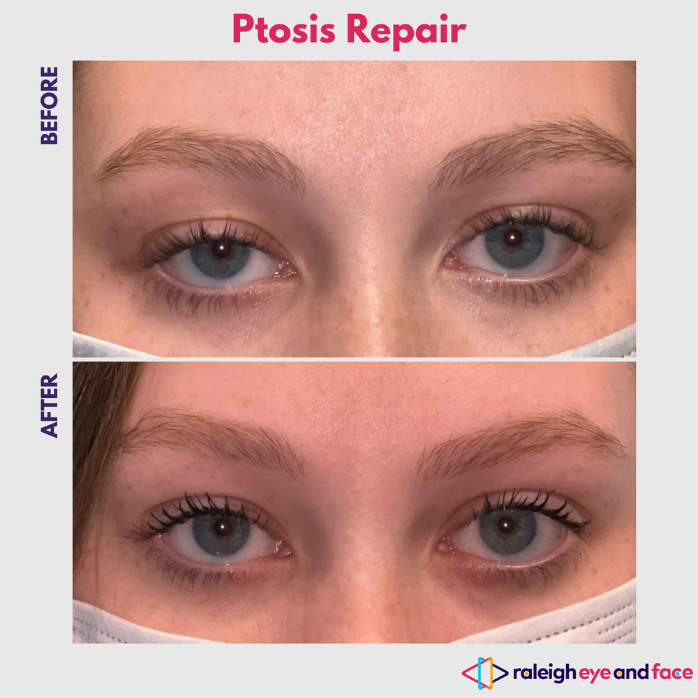 Ptosis Repair Gallery | Ptosis Repair Specialist Raleigh — Raleigh Eye ...