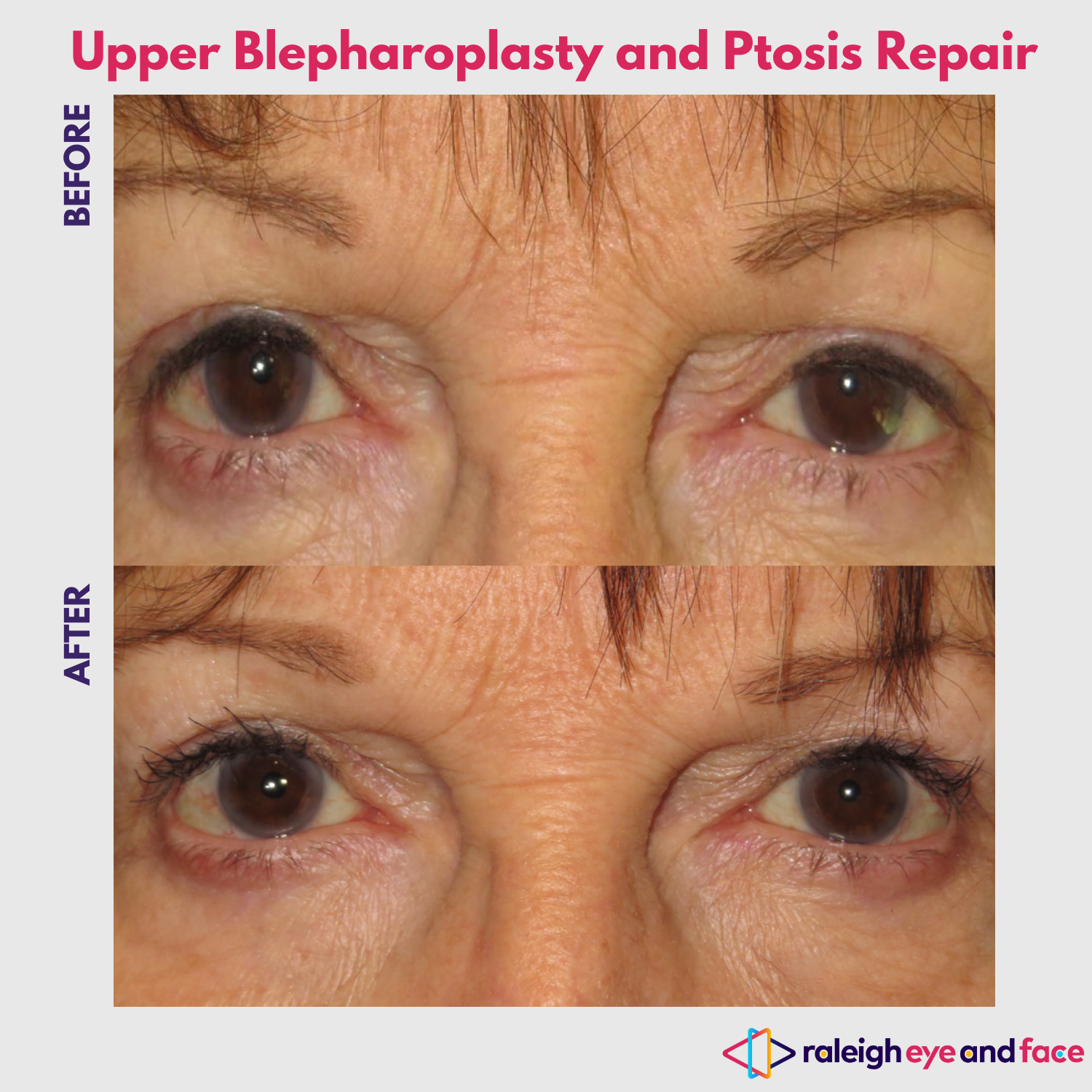 Upper Blepharoplasty Before and After Gallery — Raleigh Eye and Face
