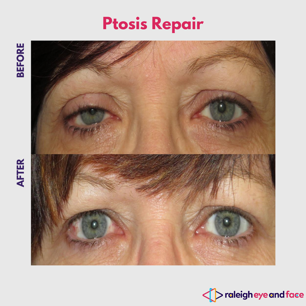 Ptosis Repair Gallery Ptosis Repair Specialist Raleigh — Raleigh Eye And Face