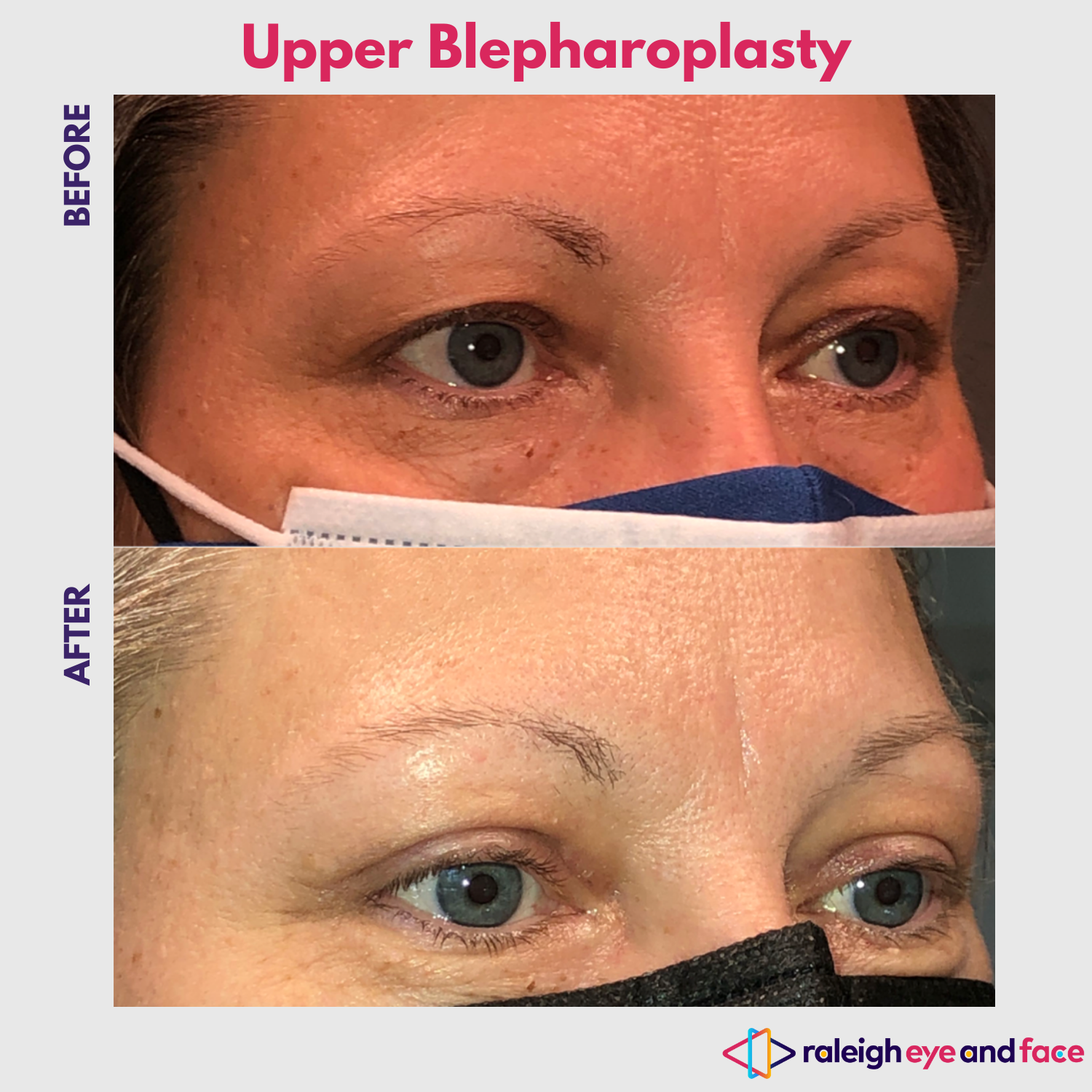 Upper Blepharoplasty Before and After Gallery — Raleigh Eye and Face