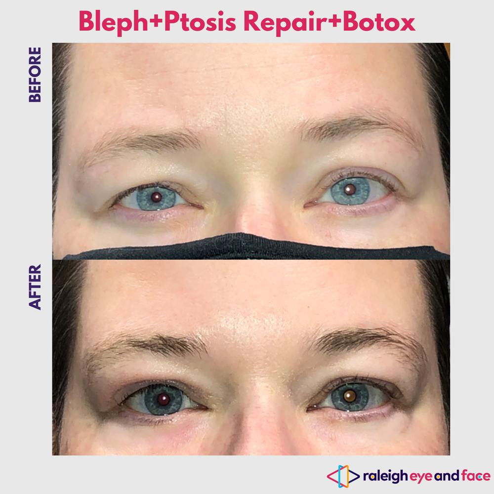 Ptosis Repair Research Triangle | Ptosis Specialist Raleigh — Raleigh ...