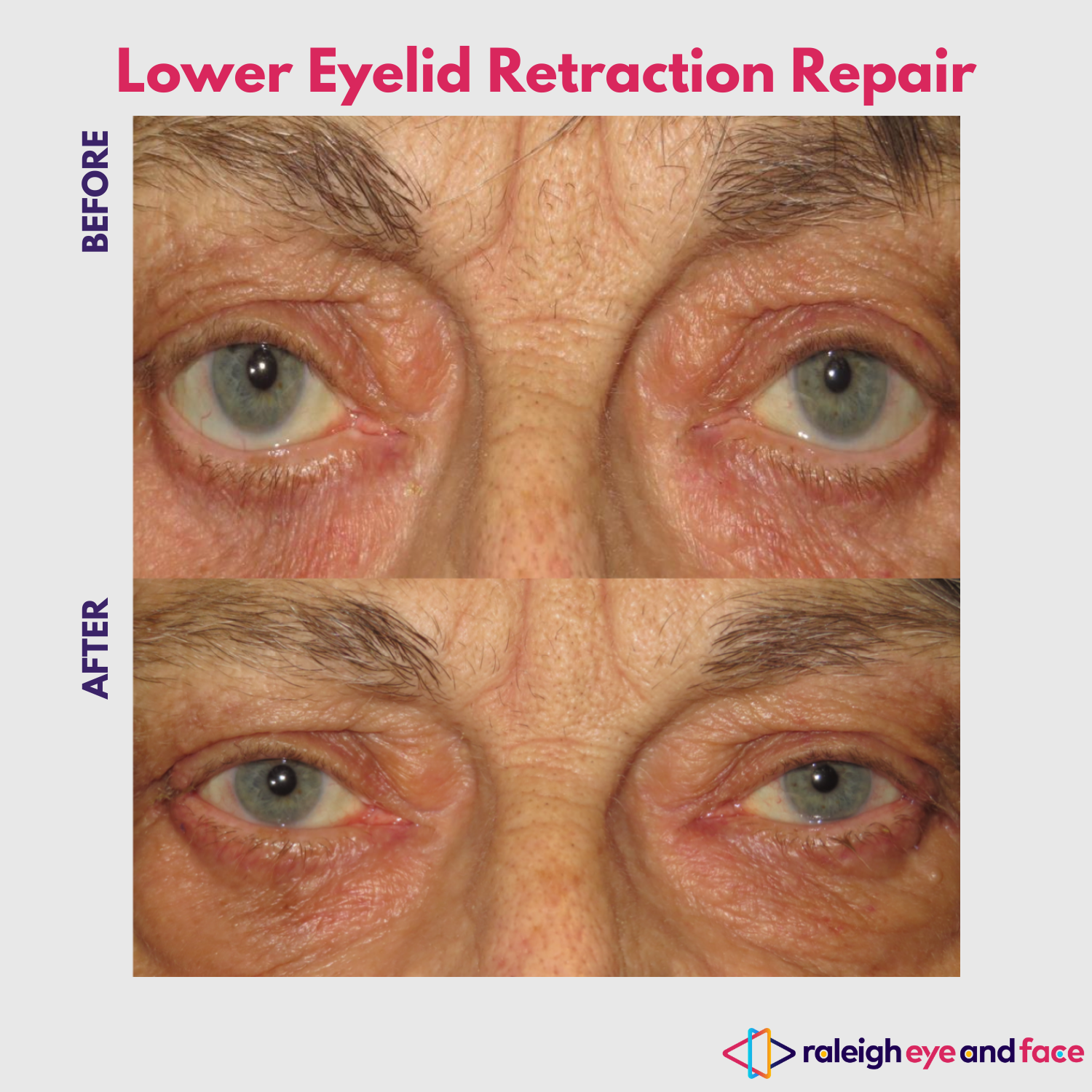 General Before and After Gallery — Raleigh Eye and Face