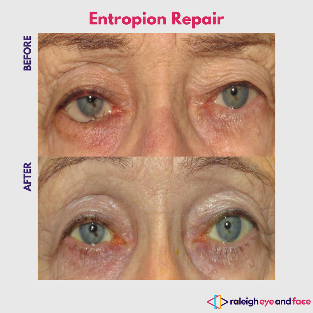 General Before and After Gallery — Raleigh Eye and Face