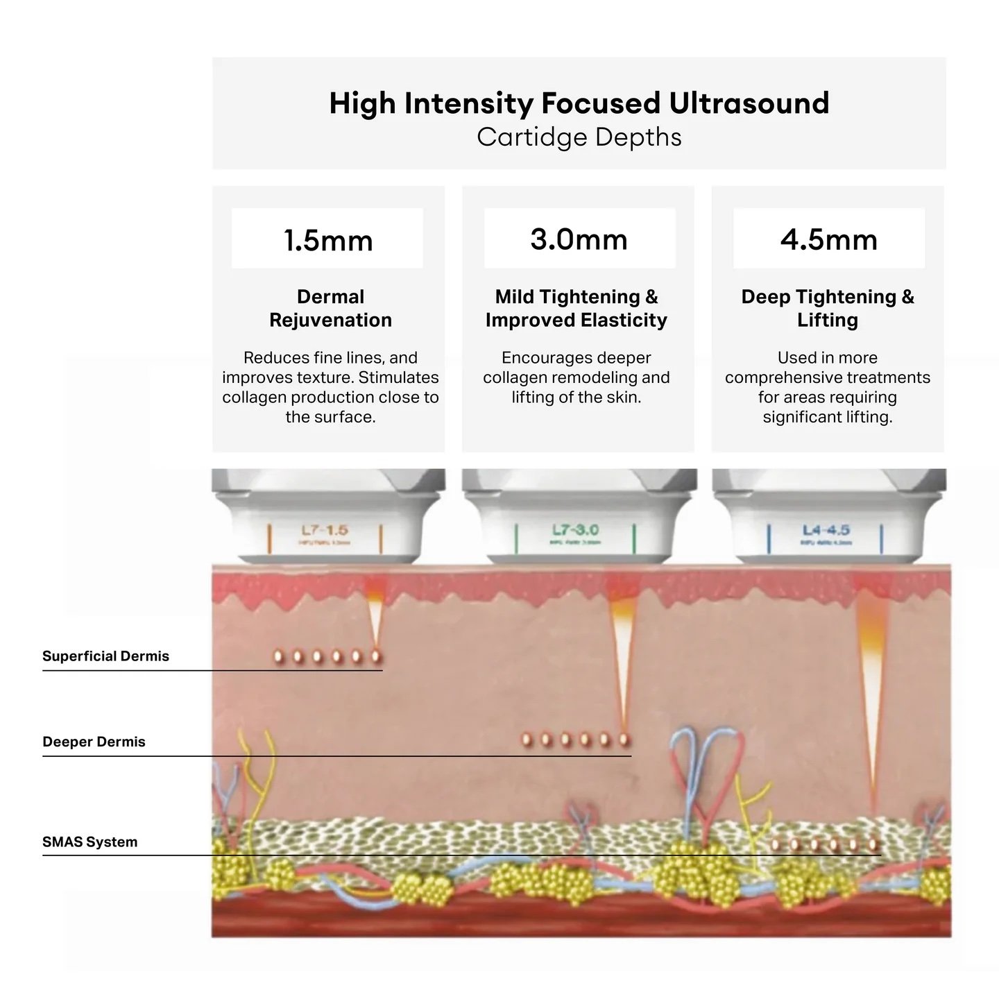 HIFU FACIAL LIFT TREATMENT — Beaches Beauty Avalon