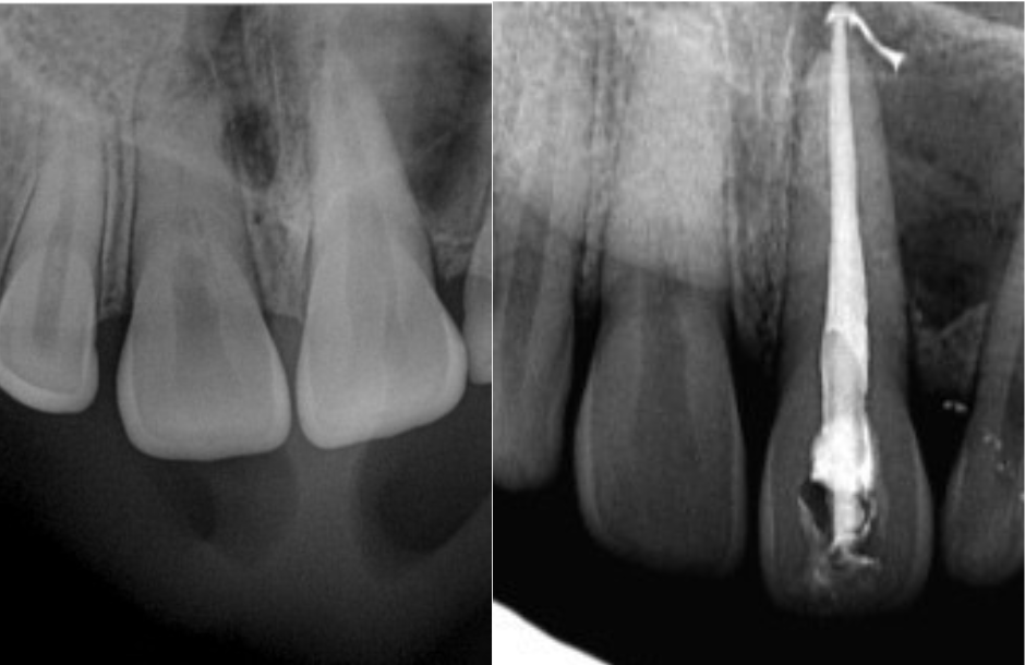 Endodoncia Tratamiento — Ligonier Family Dentistry