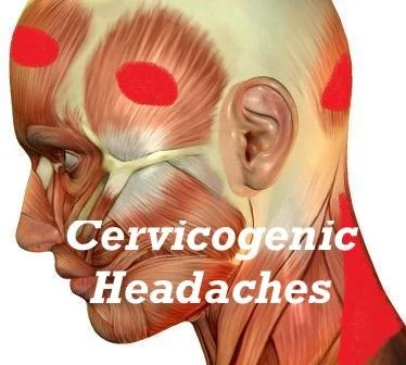 Cervicogenic headaches come from the neck.