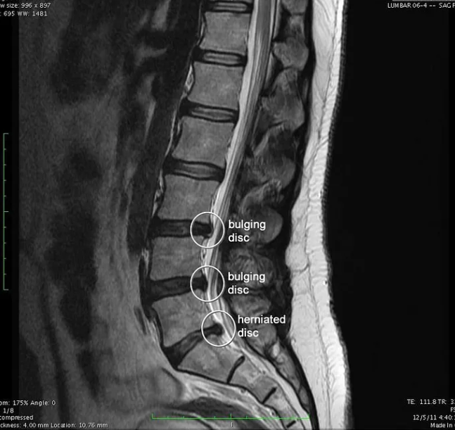 Who Treats Sciatica in East Grinstead? - Osteo Studio