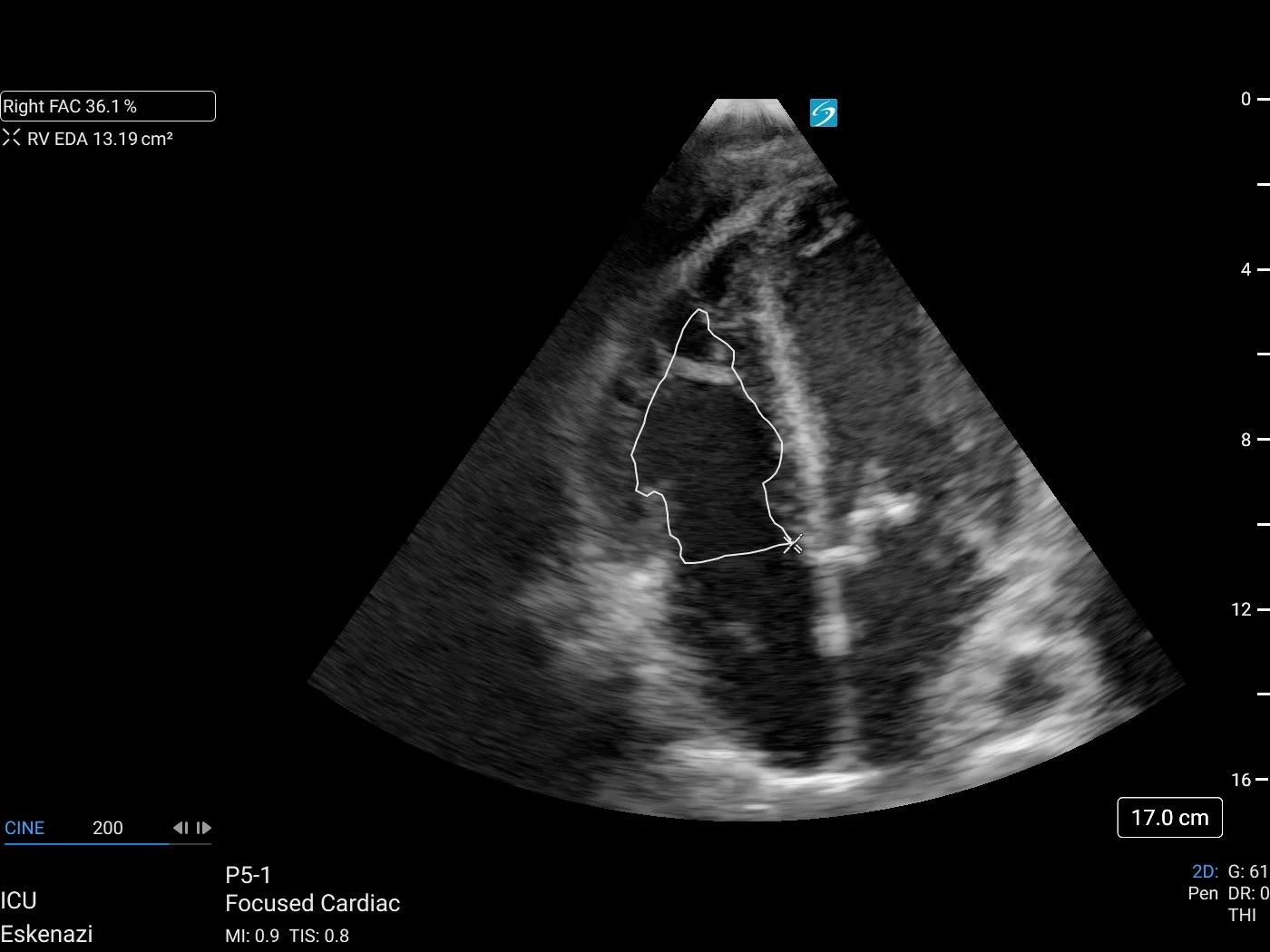 Fractional Area Change — Pulmonary POCUS